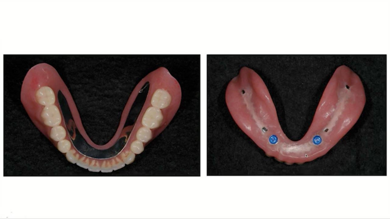 IOD/インプラントオーバーデンチャーとは【歯科用語コラム】 | Doctorbook academy
